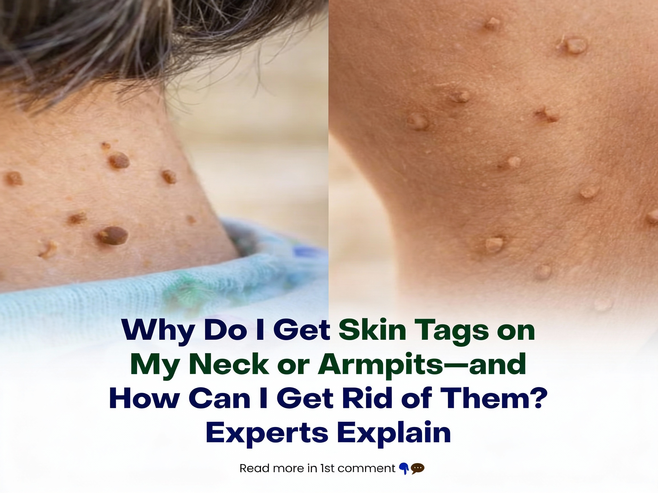 Why Do Skin Tags Appear on the Neck or Armpits—and How Can You Get Rid ...